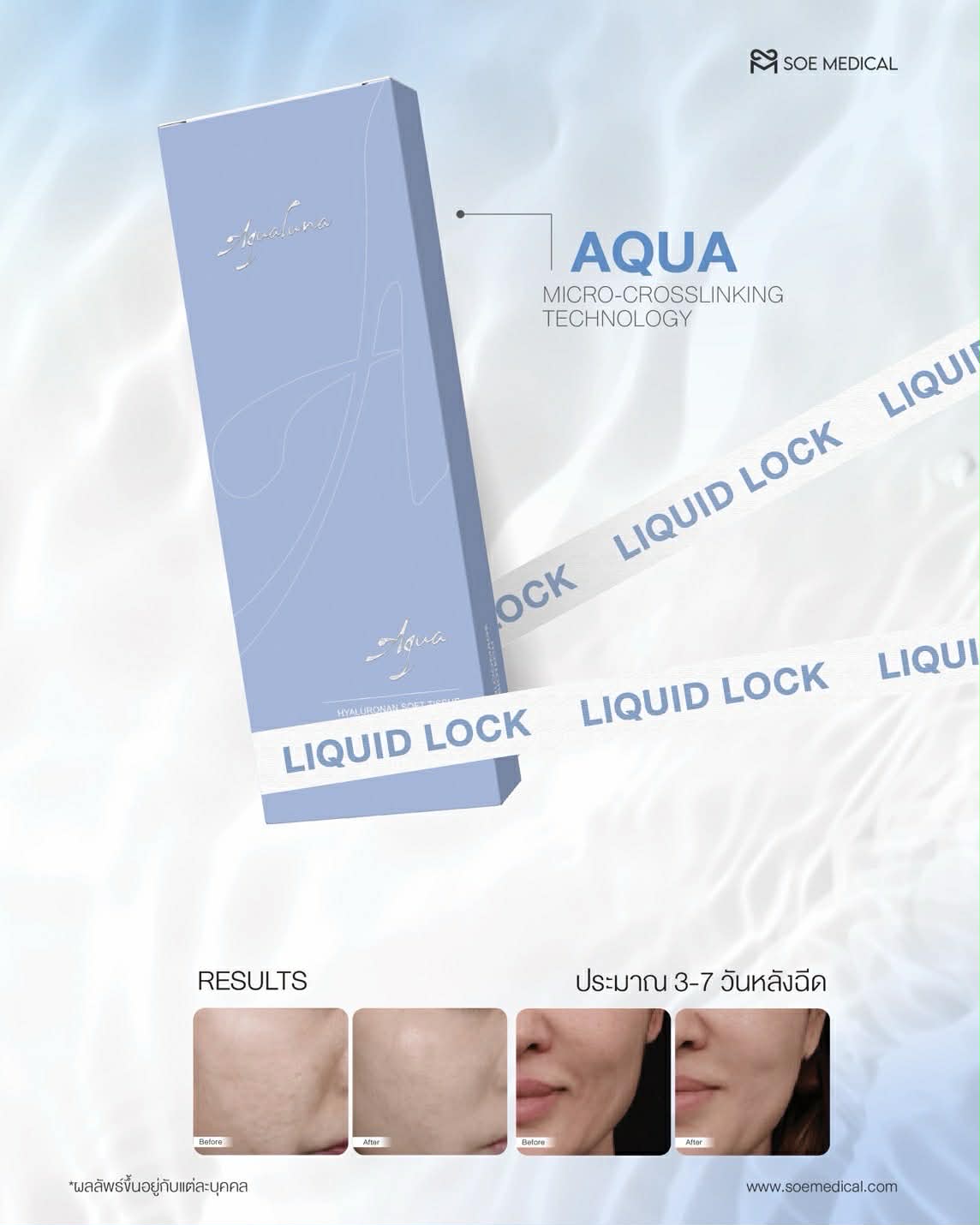 SOE Medical เปิดตัว “Aqualuna Liquid Lock” รุกตลาดเจล HA รับเทรนด์ผิว ...